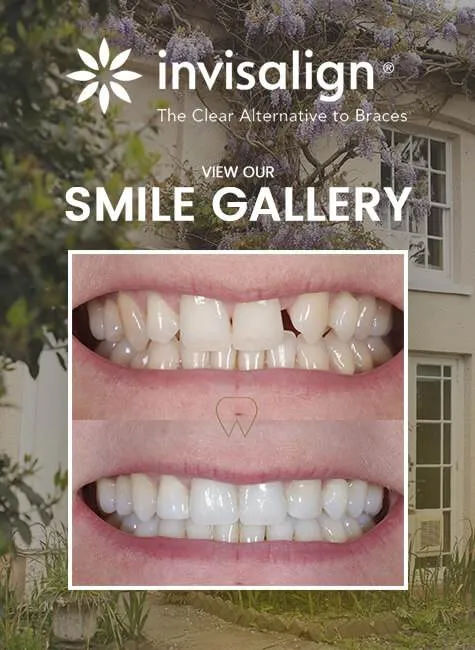 Invisalign Open Day in Crediton with Wistaria Dental